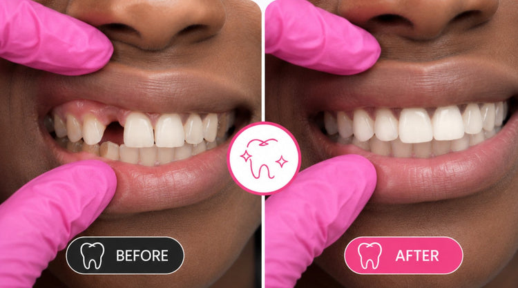 Flipper Tooth Before and After: Real Missing Tooth Smile Transformation ...
