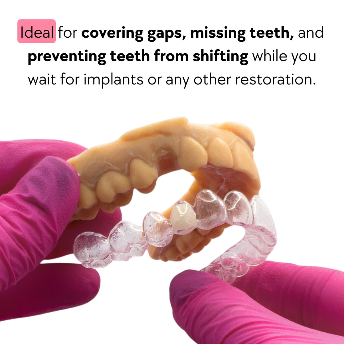 Affordable Essix Pontic Retainers: Top, Bottom, or Both – Now with ...