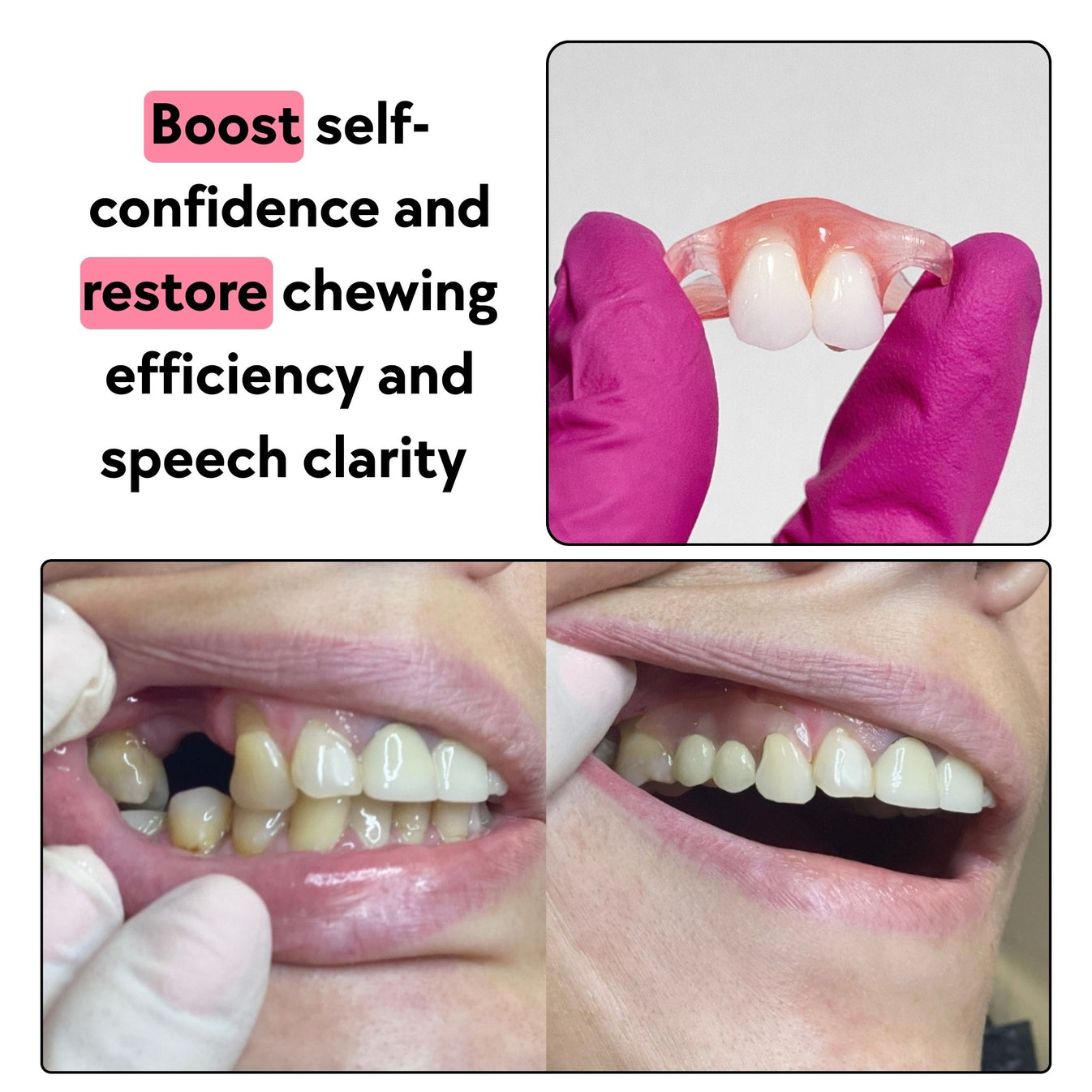 Flexible Flipper for Adults | 1–3 Teeth Front & Back Replacement ...