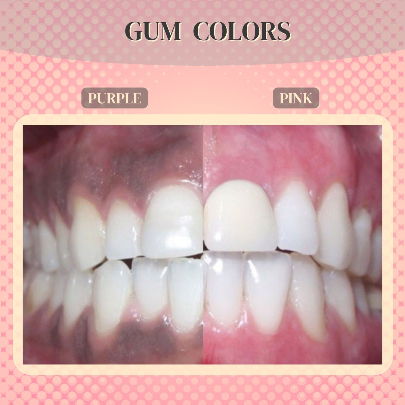 FLEXIBLE FLIPPER / DENTAL NESBIT COVERS UP TO 3 TEETH - $350 Sale